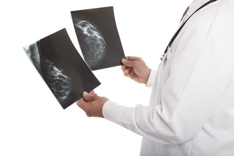 Breast density | Living Beyond Breast Cancer